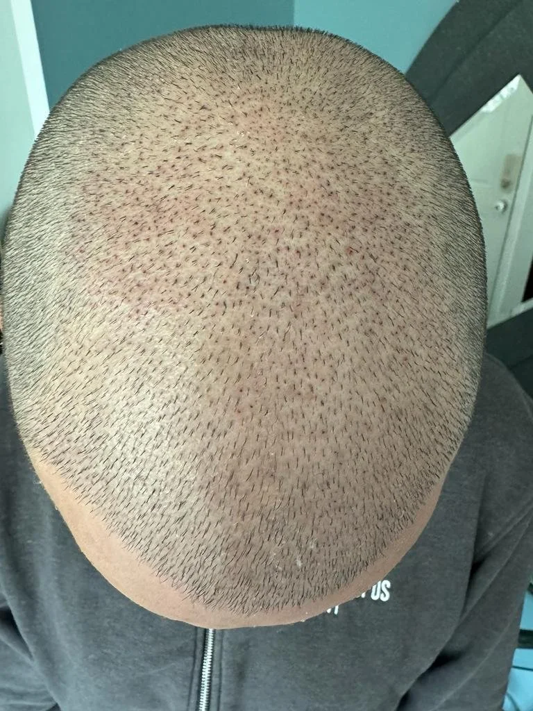 SMP Hair Tattoo by: iNKED iLLUSiONS. Transformative Scalp ...