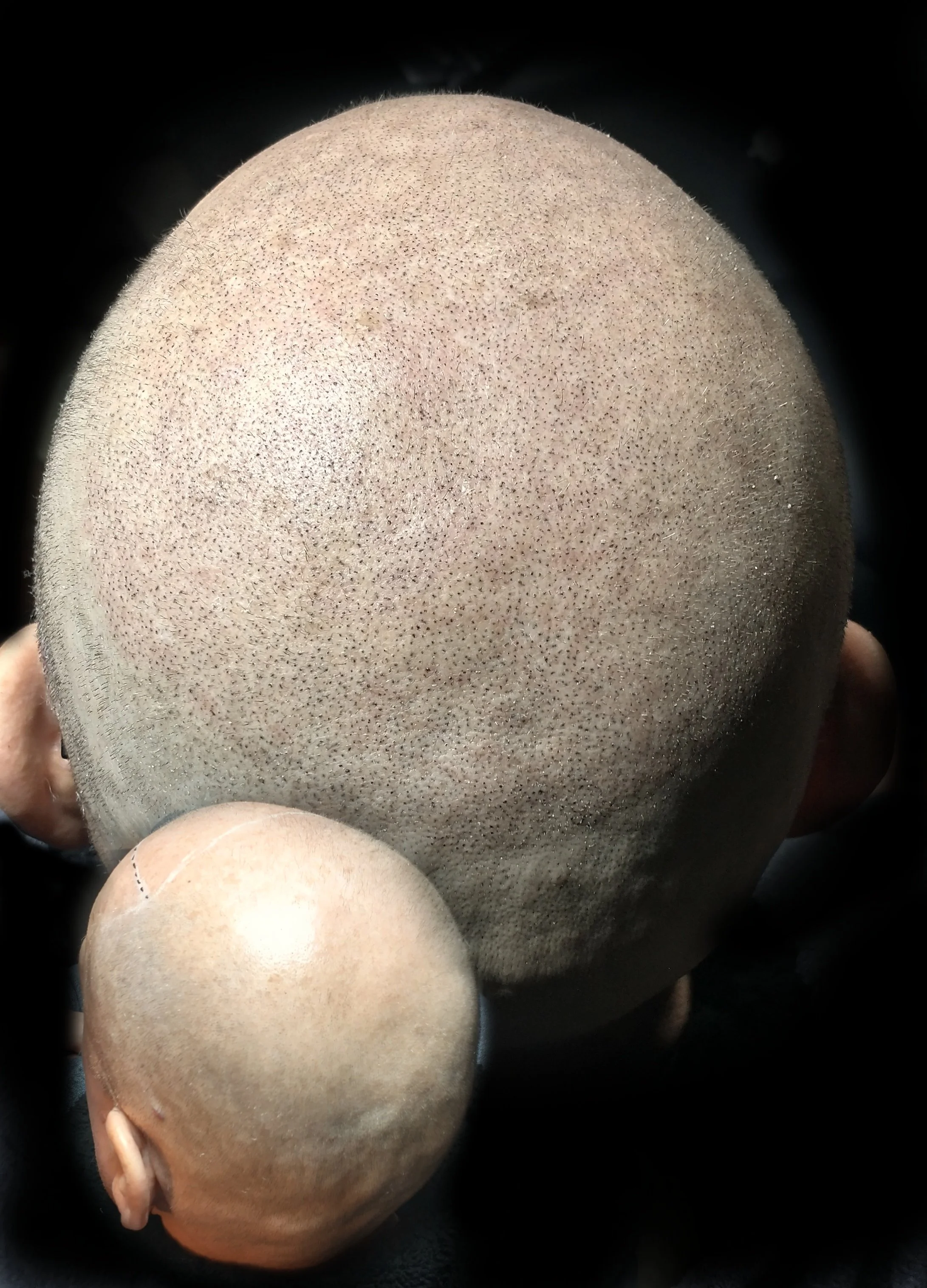 SMP Hair Tattoo by: iNKED iLLUSiONS. Transformative Scalp ...