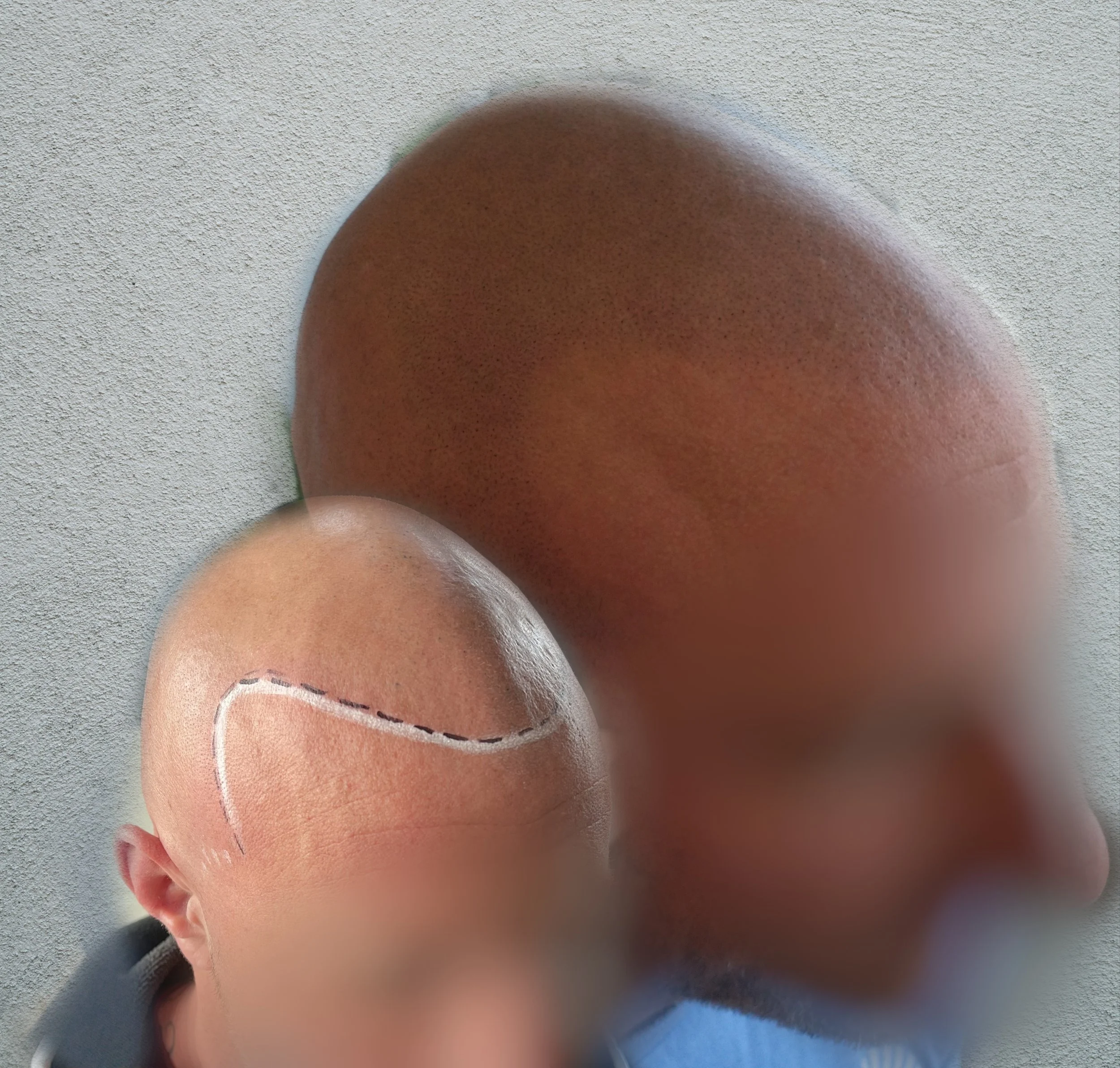 SMP Hair Tattoo by: iNKED iLLUSiONS. Transformative Scalp ...