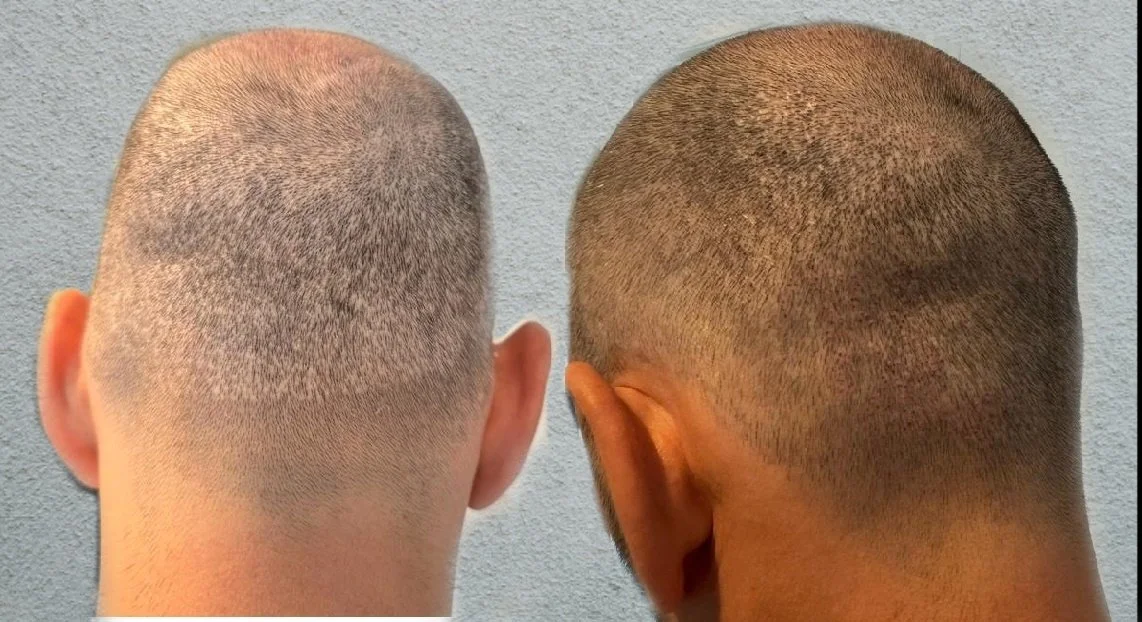 SMP Hair Tattoo by: iNKED iLLUSiONS. Transformative Scalp ...