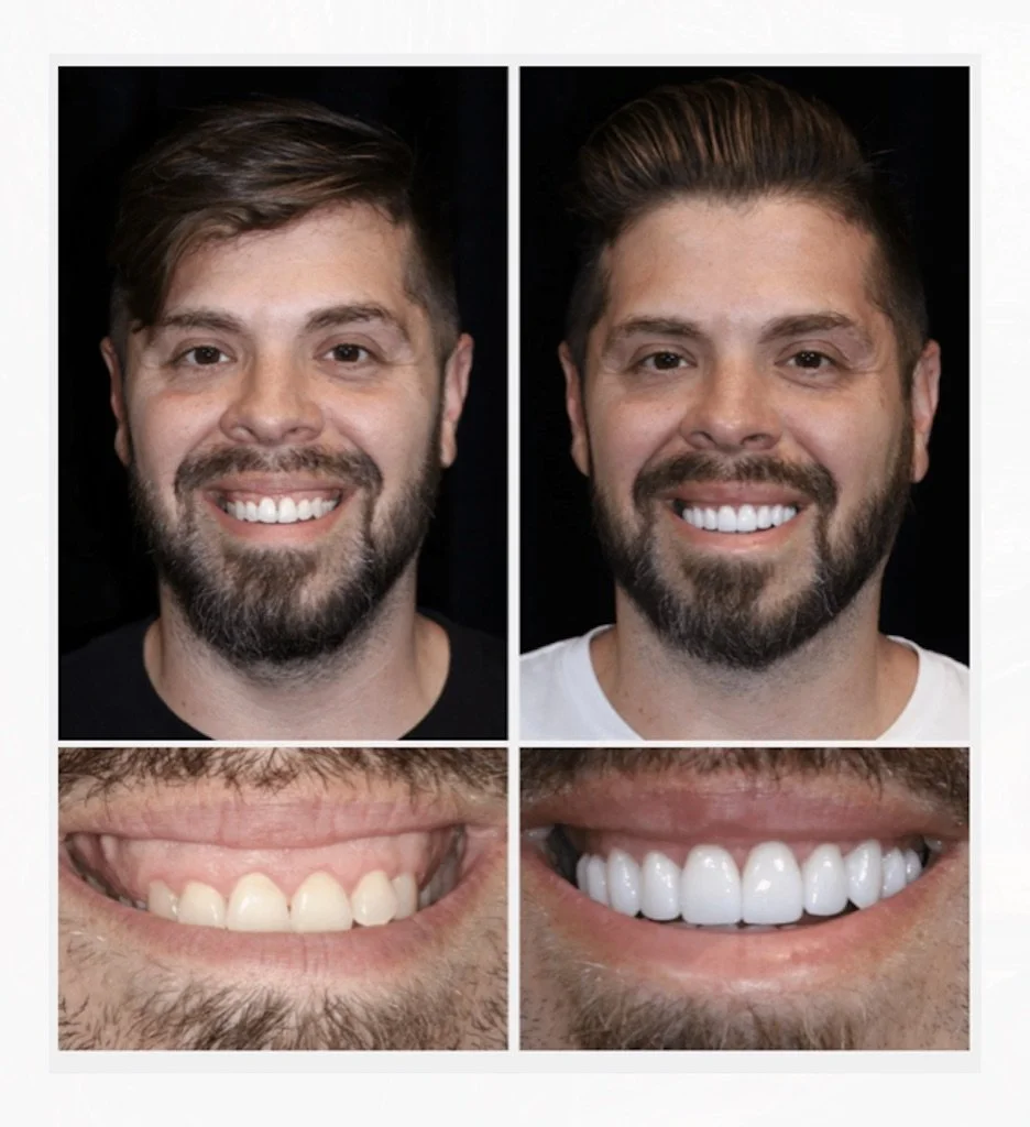 What is Gummy Smile? — Arboretum Center for Dentistry