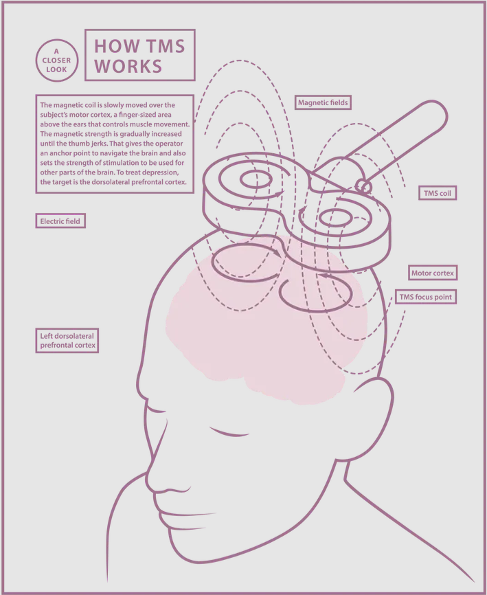 About TMS — South Bay Behavioral Health