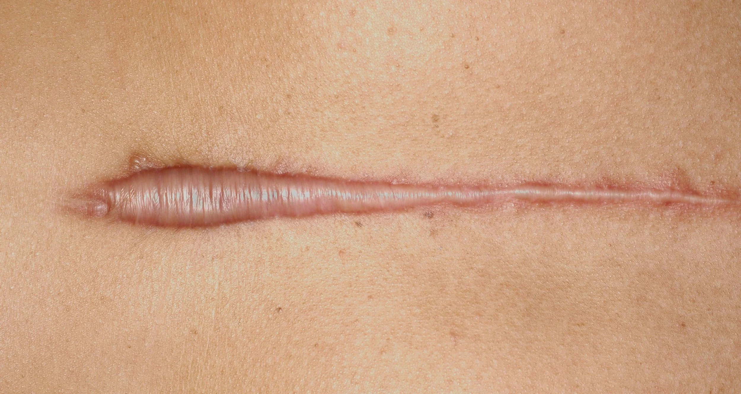 Are All Scars Equal? Scar Types and Their Differences. — Connecta ...