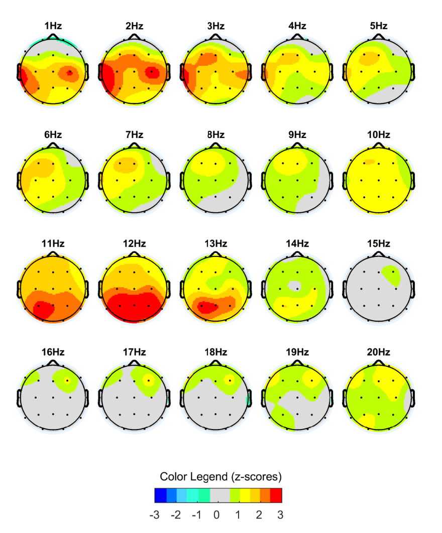 What Does a QEEG Brain Map Show? | Understand Your Brain Patterns ...