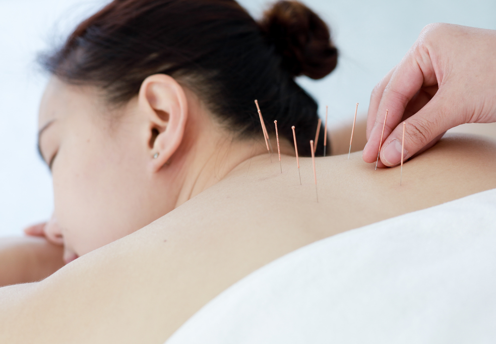 What Is Acupuncture? A Complete Guide to This Ancient Healing Practice ...