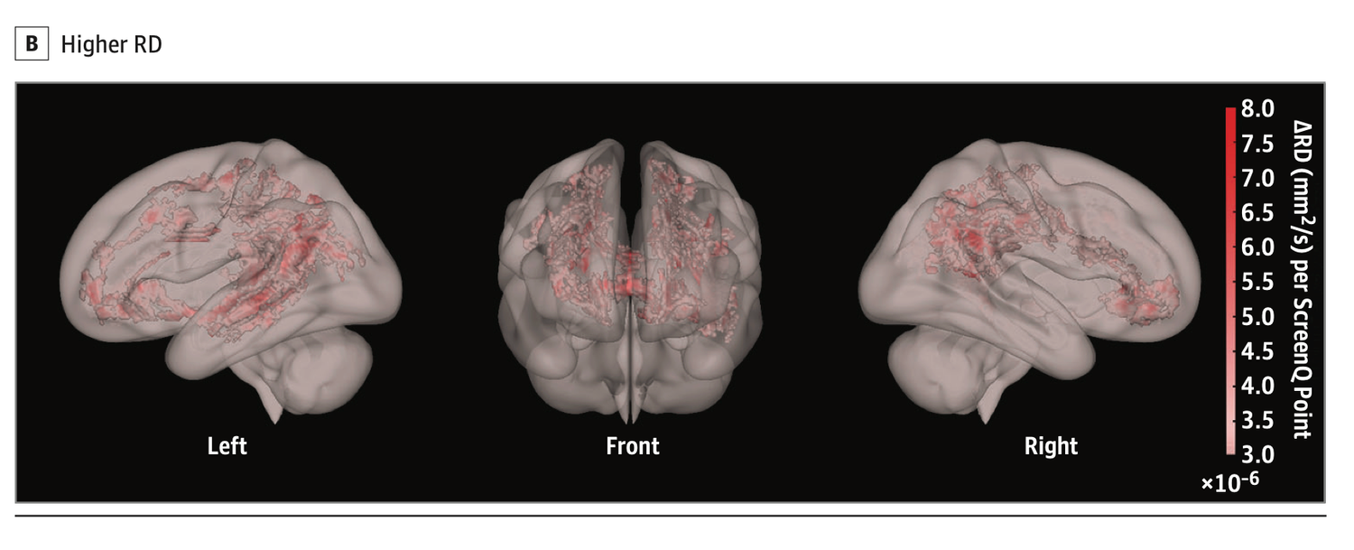 How Screen Time Could Be Affecting Young Children's Brain Development ...