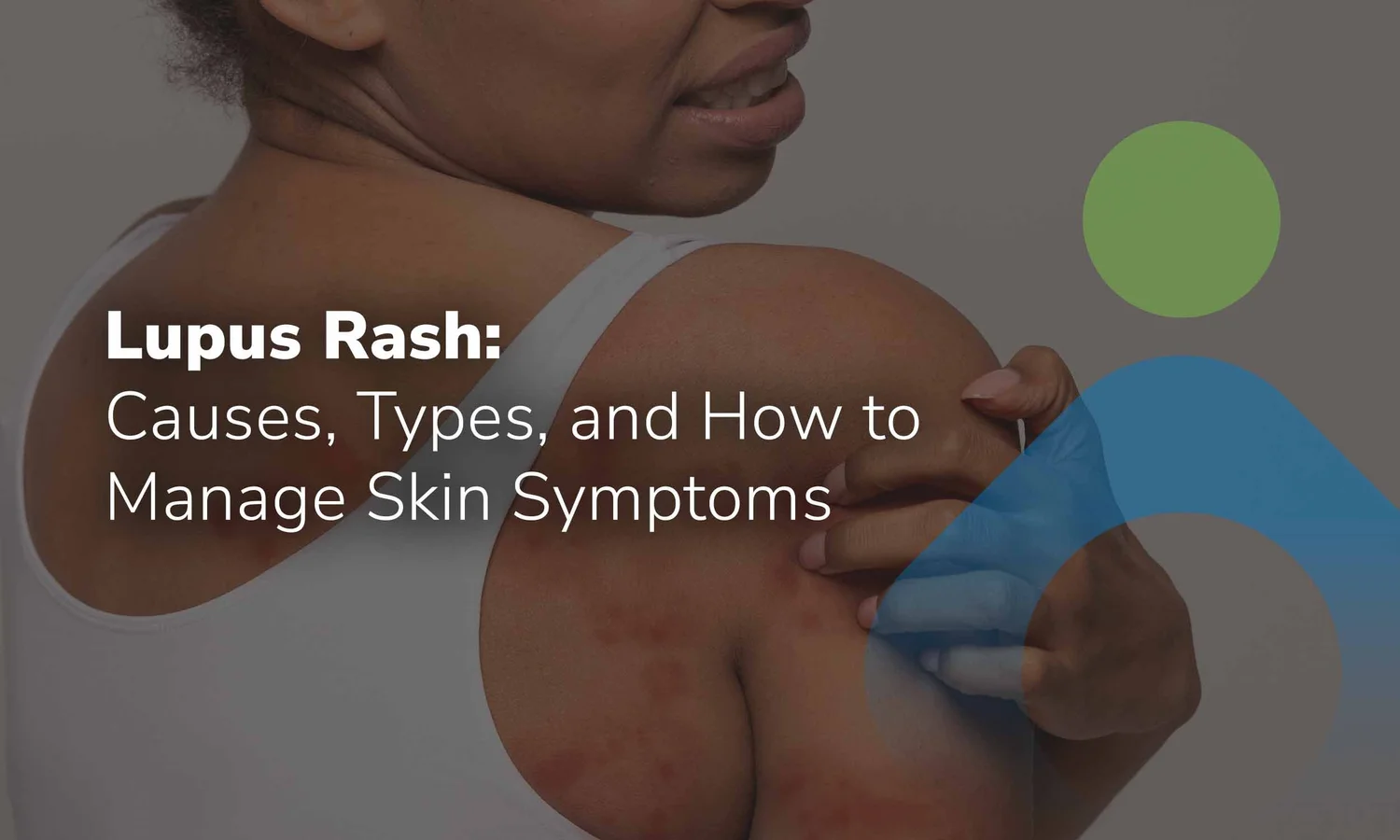 Lupus Rash: Causes, Types, and How to Manage Skin Symptoms — Plantocol