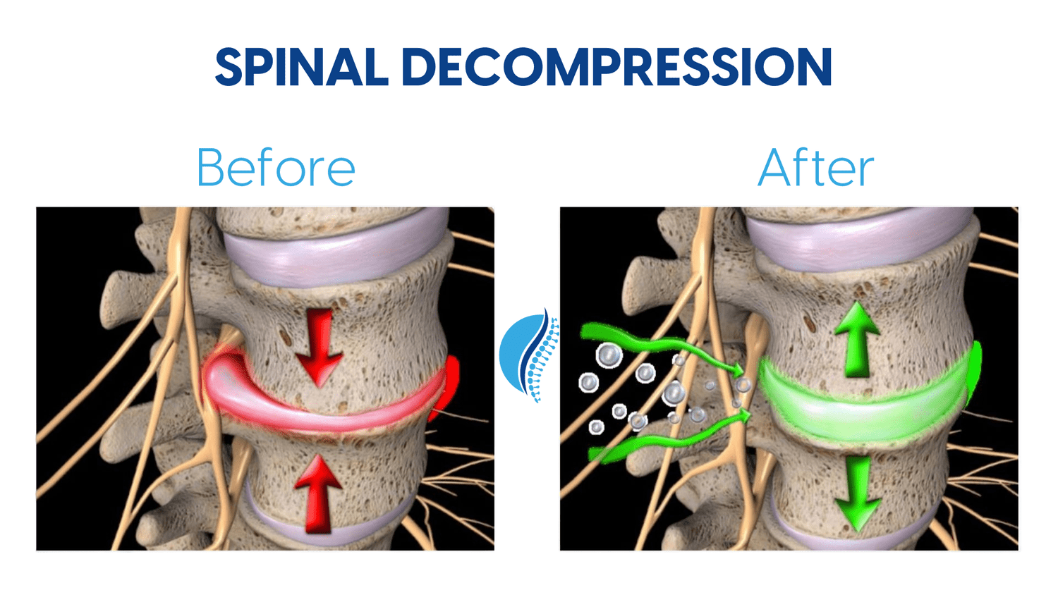 Spinal Decompression — Dr. Gary Parker Physical Therapy