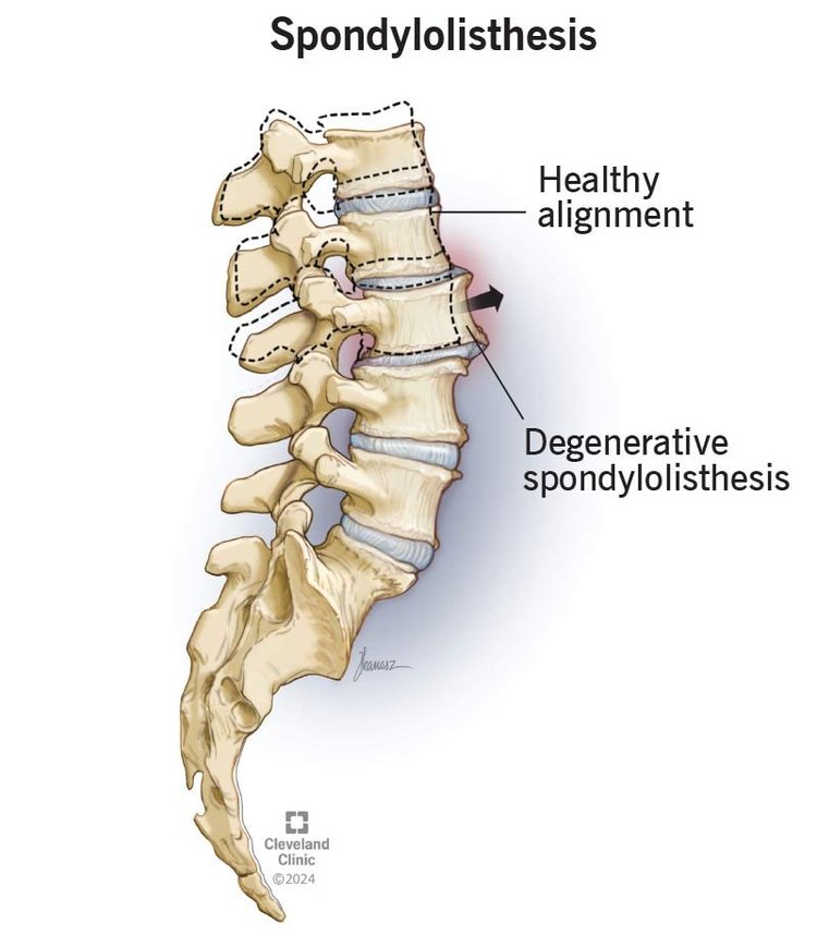 Managing Spondylolisthesis: Pilates — Yellow Pilates