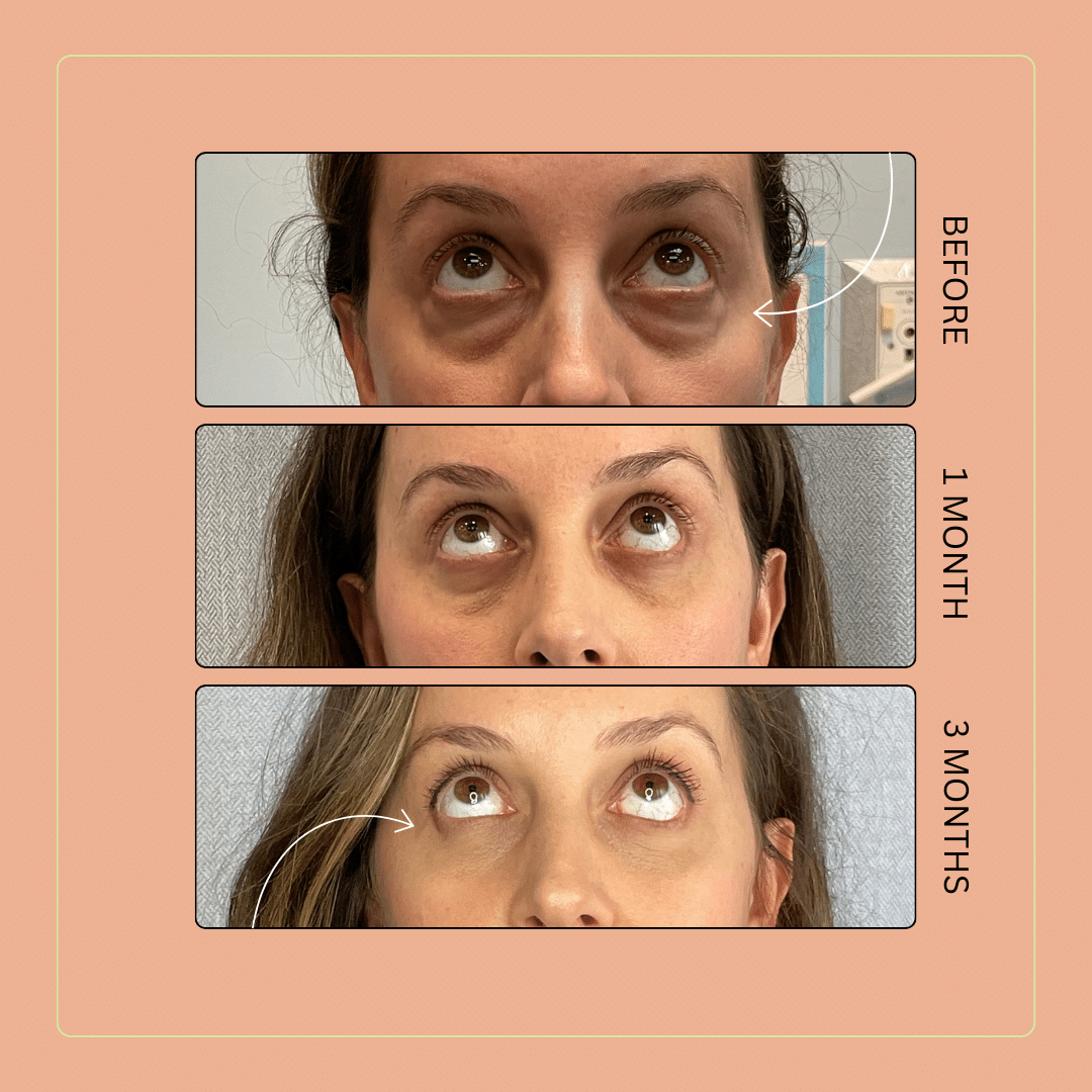 Neck Lift Surgery—Rejuvenate Your Neck & Jawline | Free Consultation — adonis.surgery