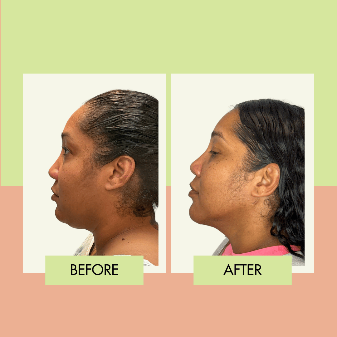 Chin Liposuction—Define Your Jawline & Boost Confidence | Torrance ...