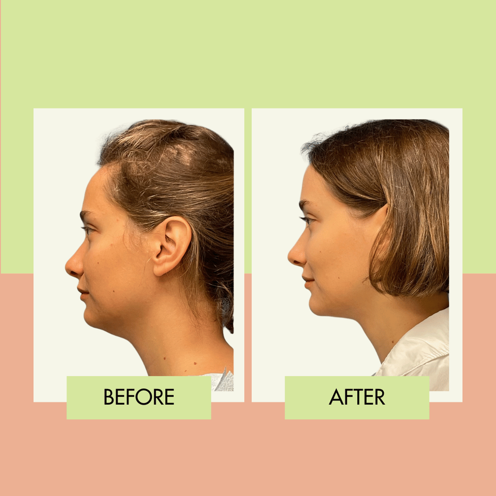 Chin Liposuction—Define Your Jawline & Boost Confidence | Torrance ...