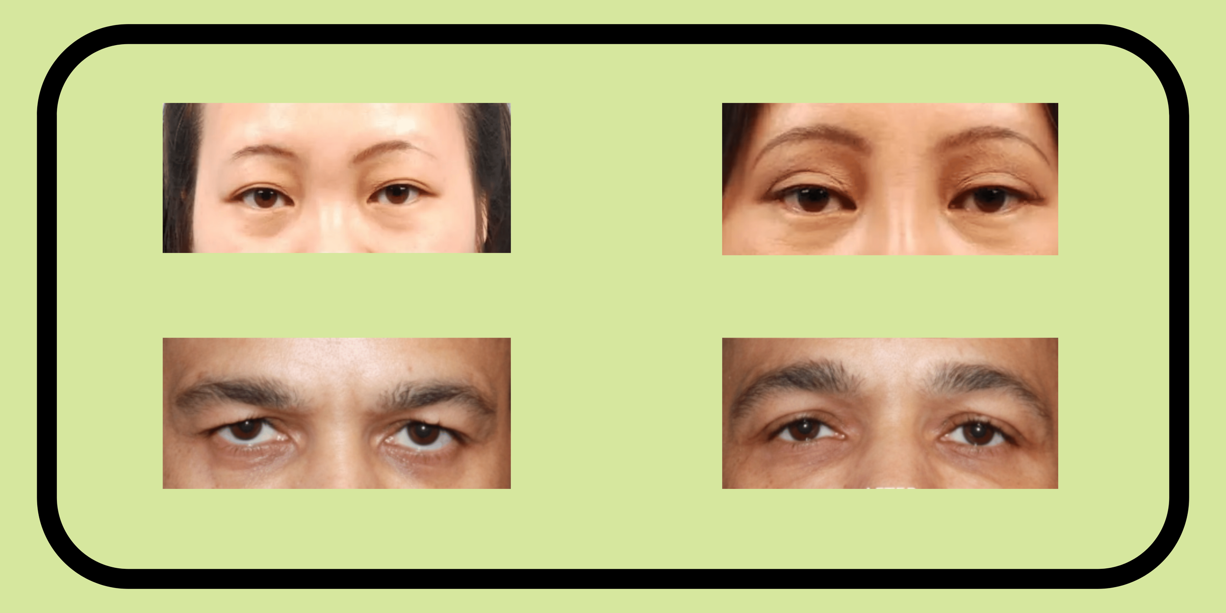 Asian Blepharoplasty — adonis.surgery