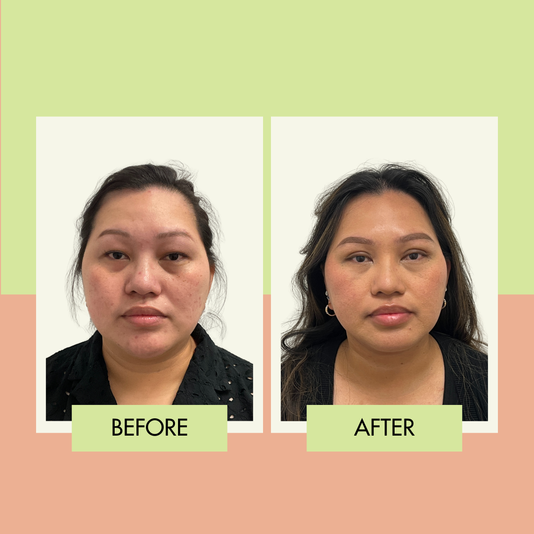 Double Eyelid Surgery in LA and Torrrance — adonis.surgery