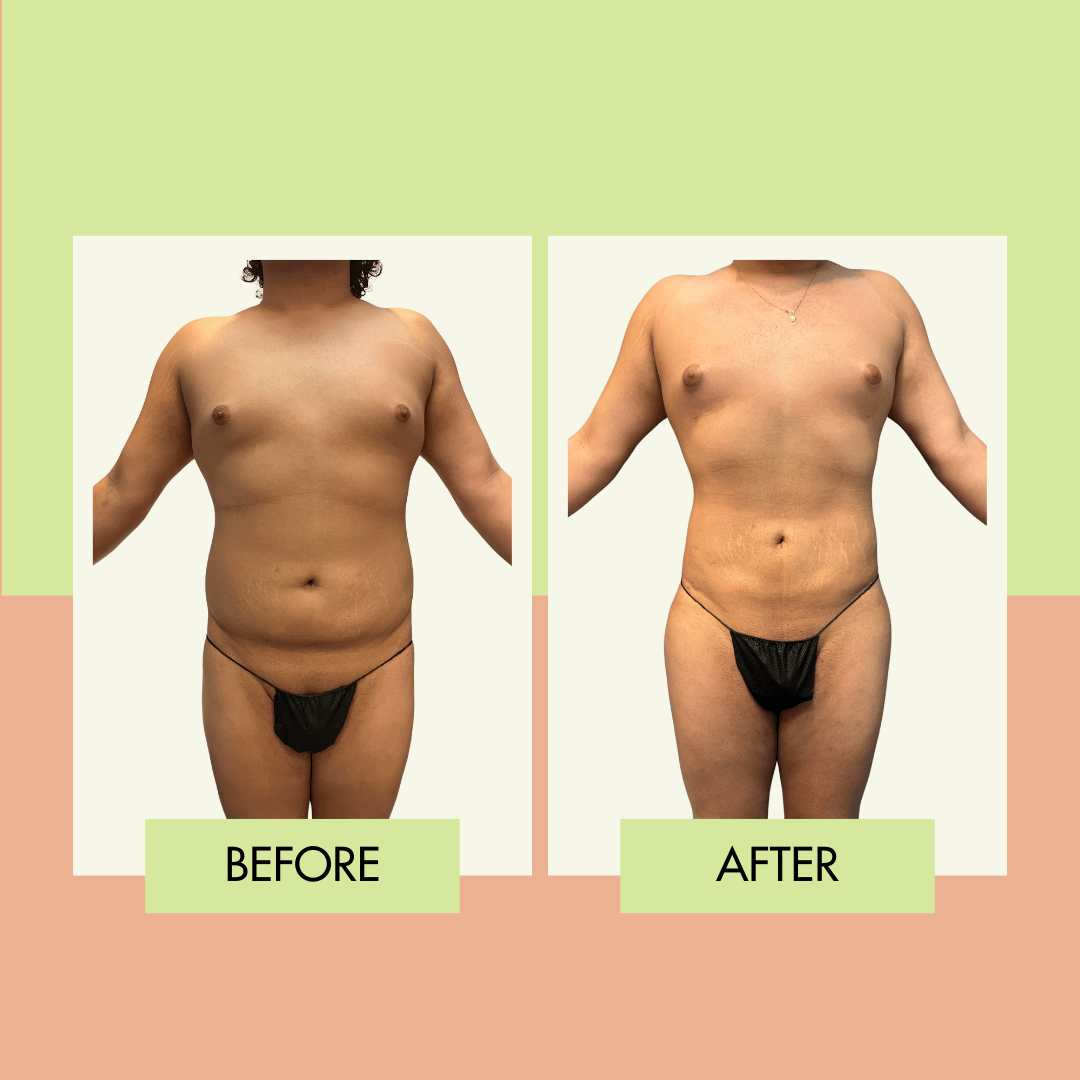360 Lipo in Los Angeles and Torrance | Adonis Surgery — adonis.surgery