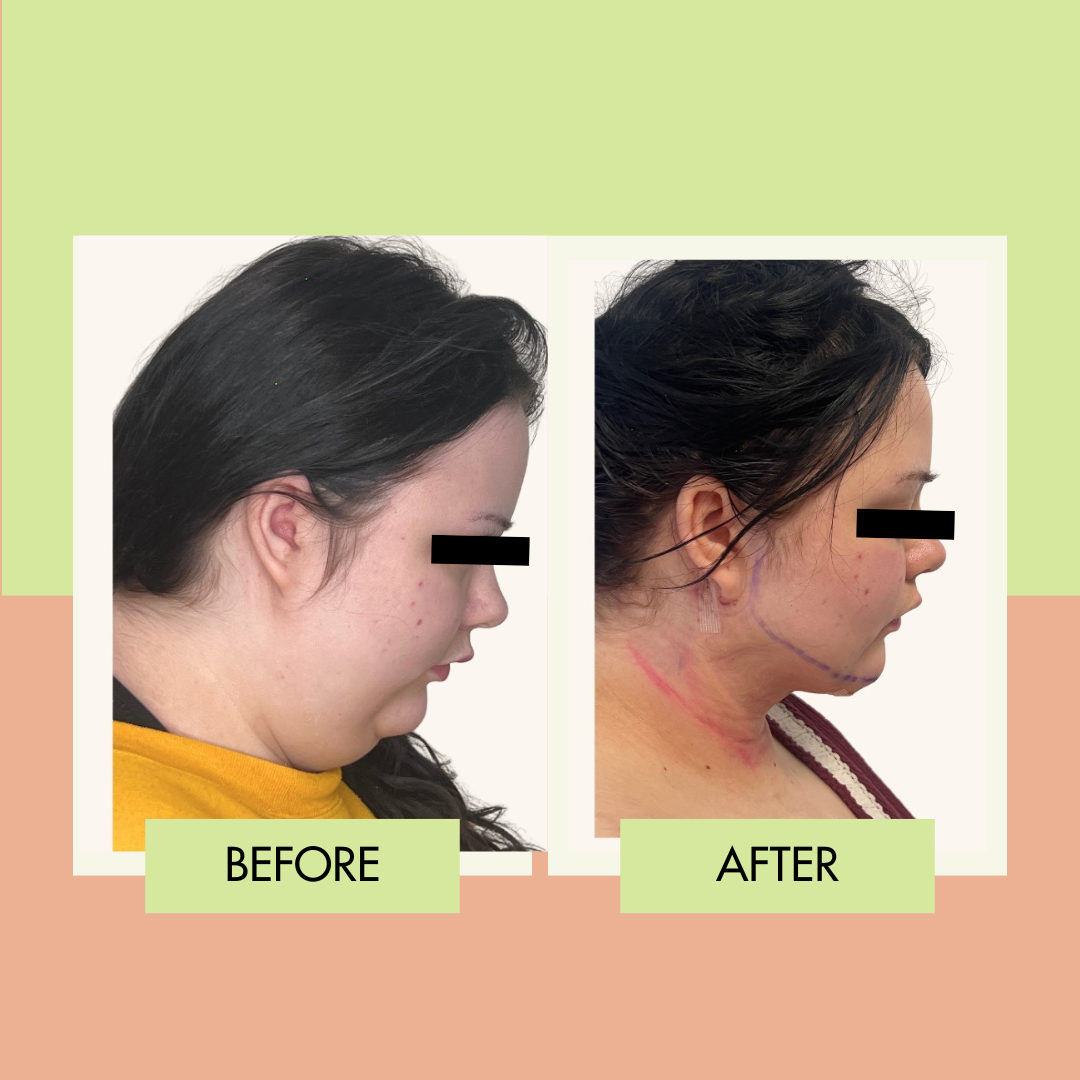 Chin Liposuction—Define Your Jawline & Boost Confidence | Torrance ...