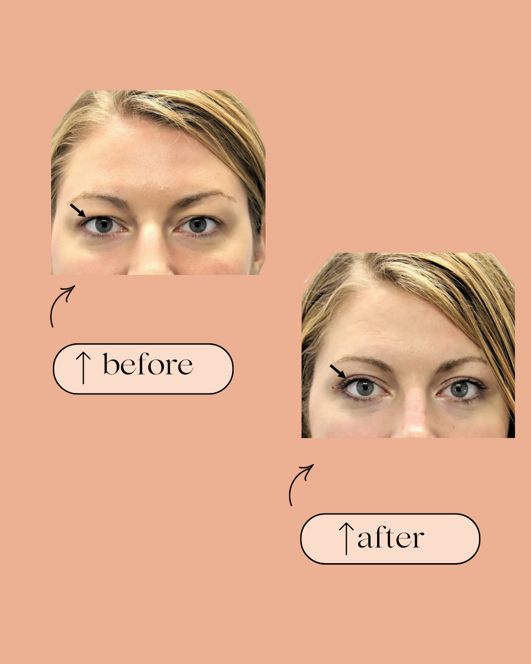 Upper Eyelid Surgery | Expert Upper Blepharoplasty for Youthful Eyes in Adonis Plastic Surgery ...