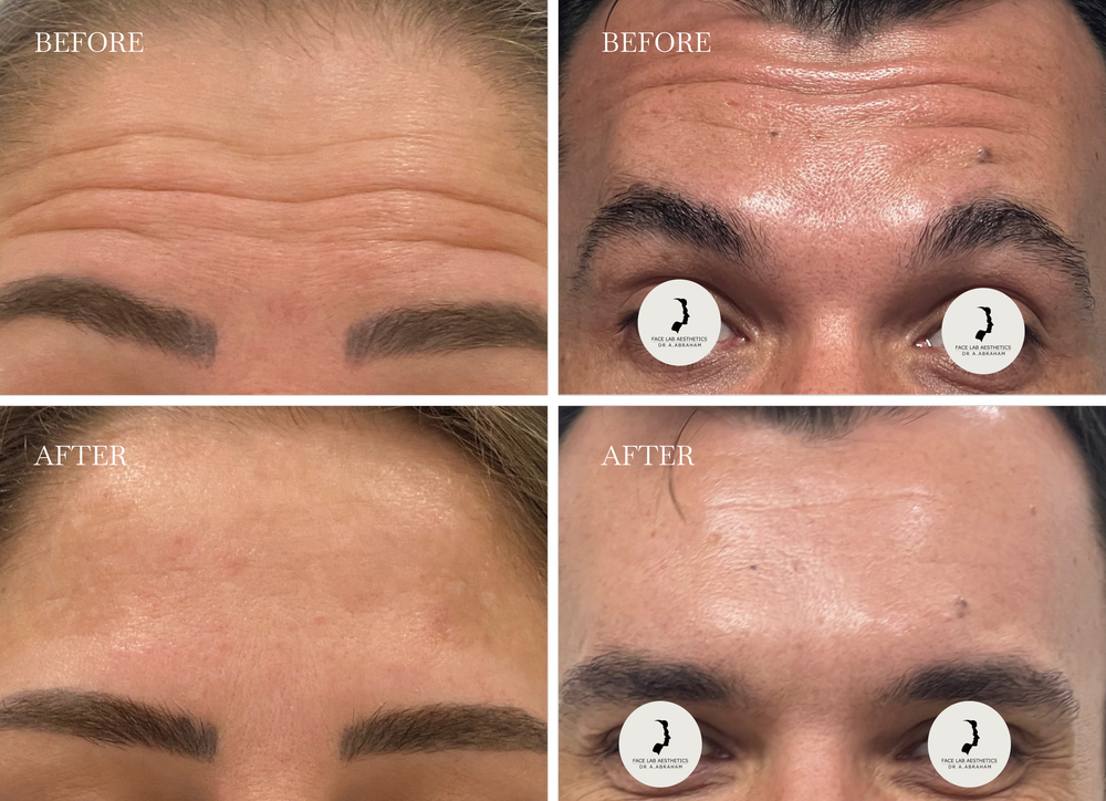 Full Face & Neck Anti-Wrinkle Treatment London | Face Lab — Face Lab ...