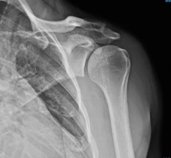 Shoulder Fractures & AC Joint Injuries — Marie Walcott, MD