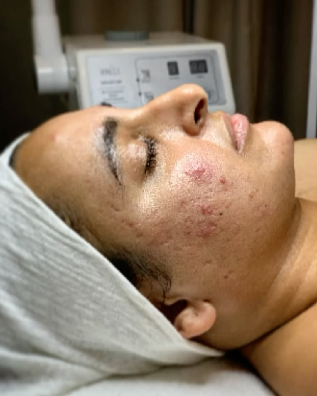 Acne Safe Ingredient Check — JE'DERM skin atelier