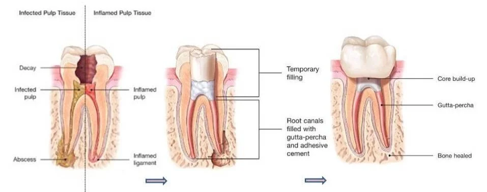Treatments — Crest Endodontics