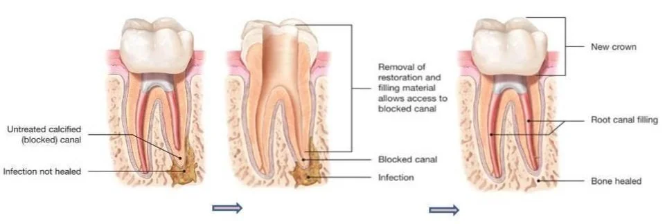 Treatments — Crest Endodontics