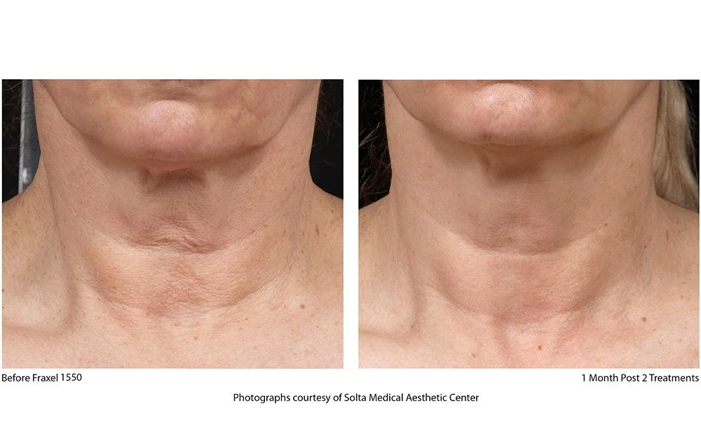 FRAXEL Laser — Dermatology Specialists of Greater Cincinnati