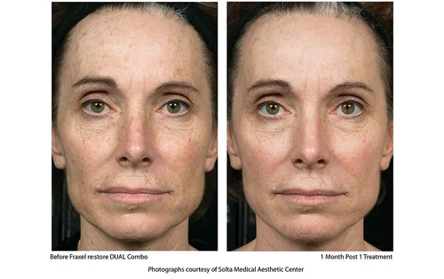 FRAXEL Laser — Dermatology Specialists of Greater Cincinnati