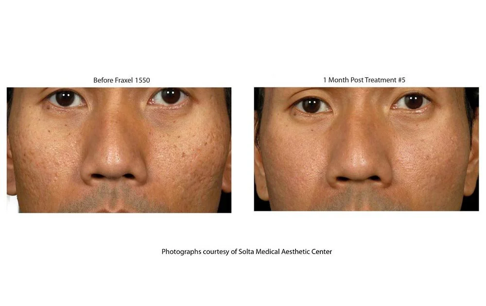 FRAXEL Laser — Dermatology Specialists of Greater Cincinnati