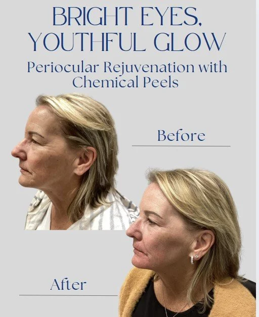 Bright Eyes, Youthful Glow: Periocular Rejuvenation with Chemical Peels ...