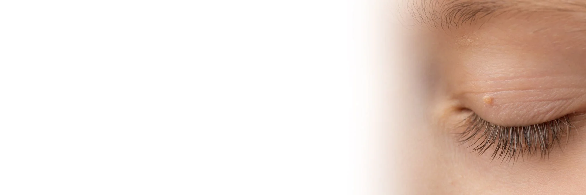Benign Growth Removal — Dermatology Specialists of Greater Cincinnati
