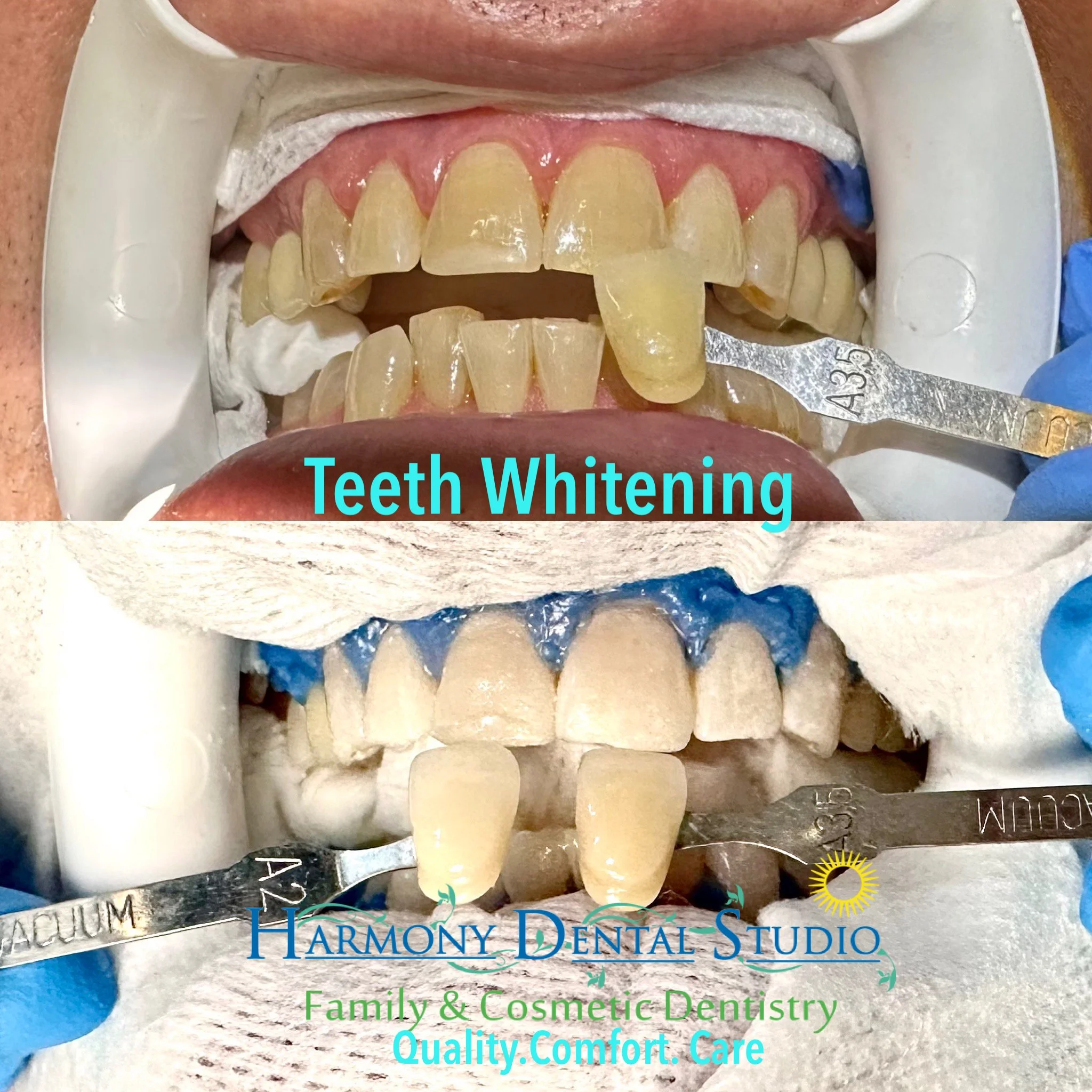 Teeth Whitening — Harmony Dental Studio