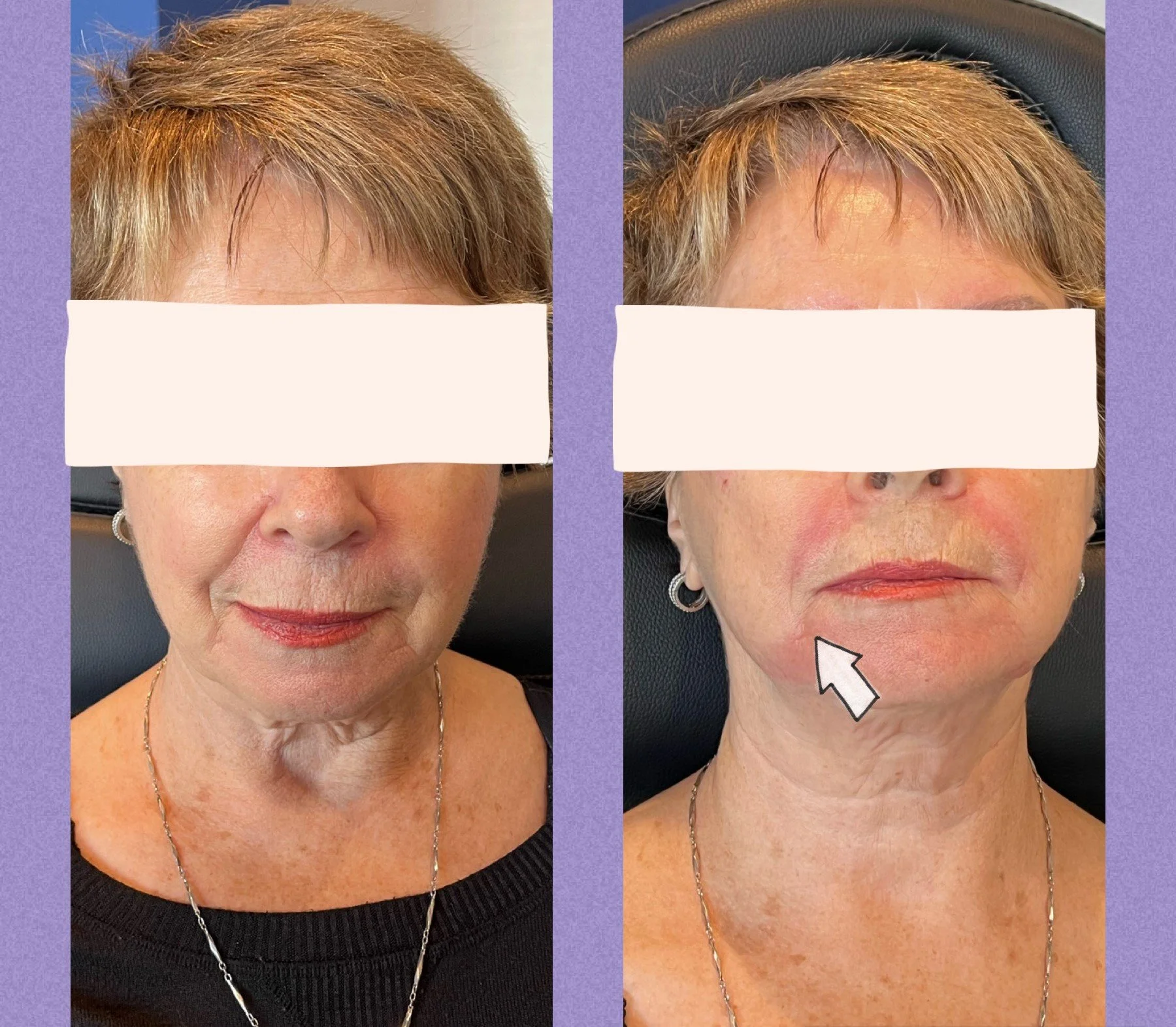 Filler — dr sheida naderi-azad