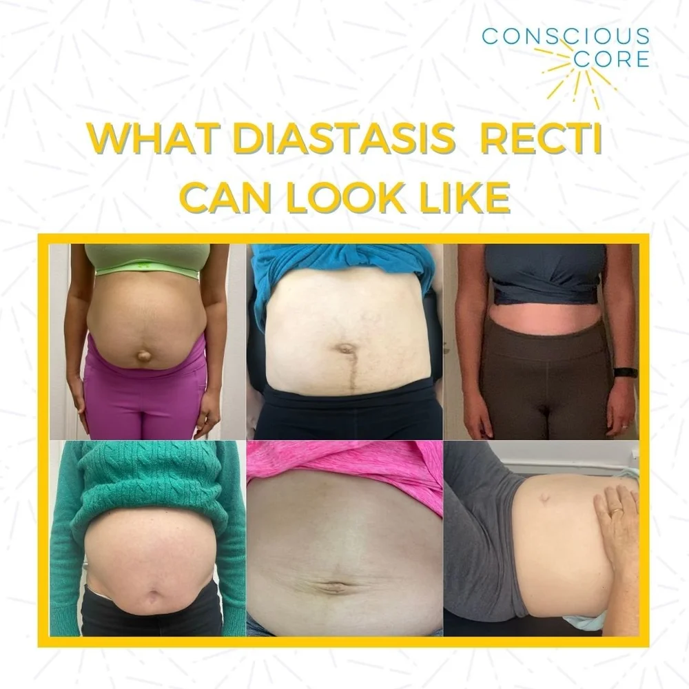 Diastasis Recti Awareness: What it looks and feels like — Conscious ...