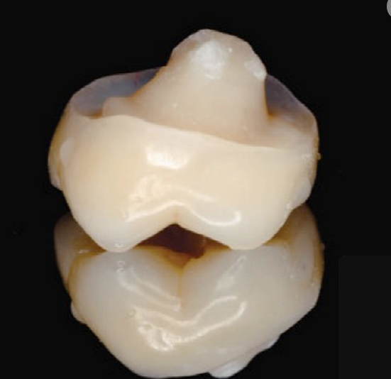 3D Printed EndoCrown and EndoVeneer — Rodin Implants