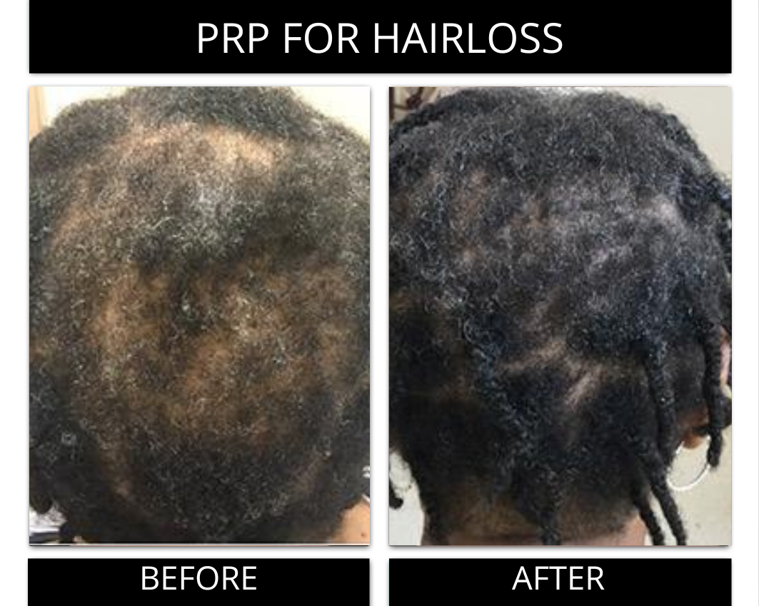 Hair Restoration Results