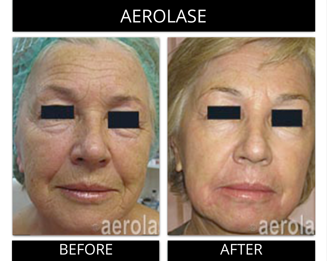 Aerolase Laser Treatment | Gambrills MD