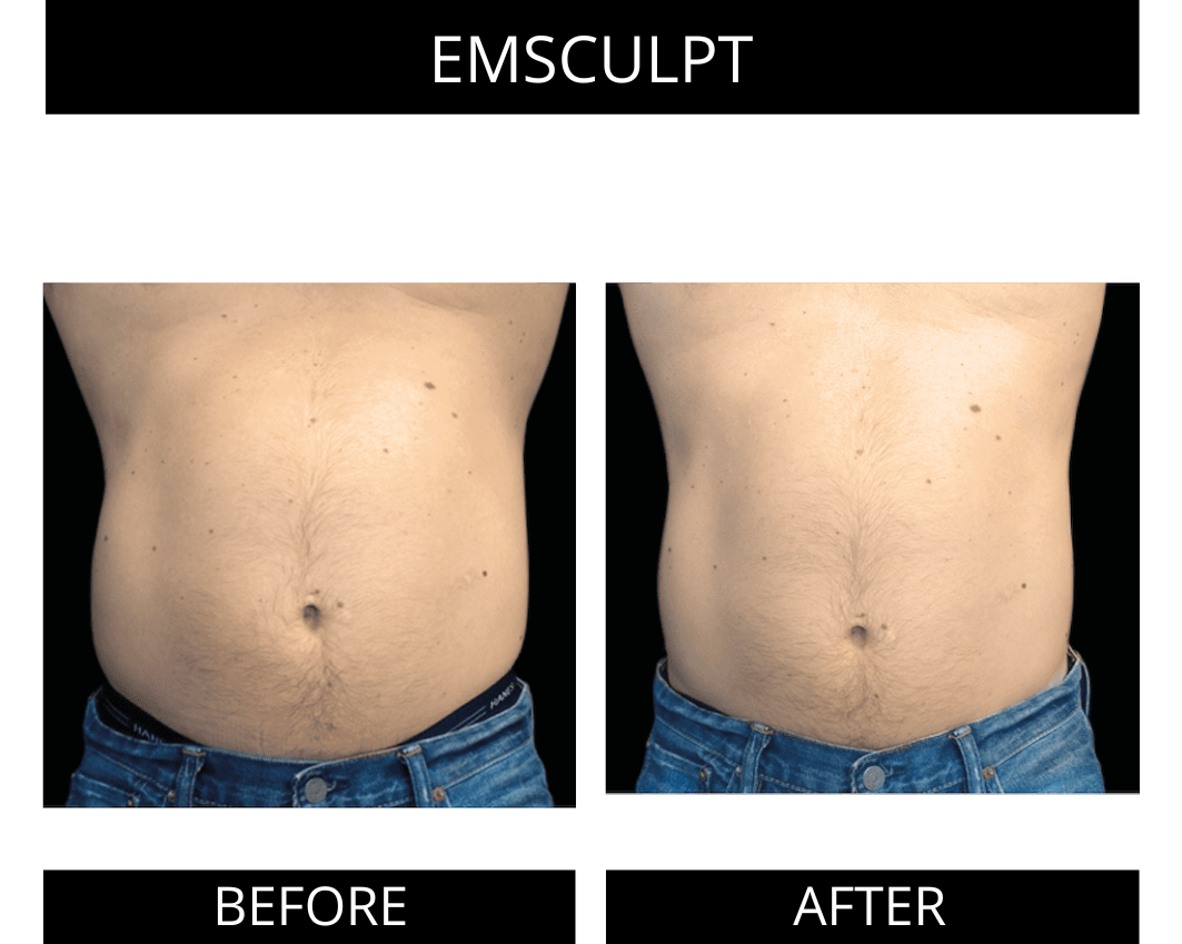 Body Contouring Results