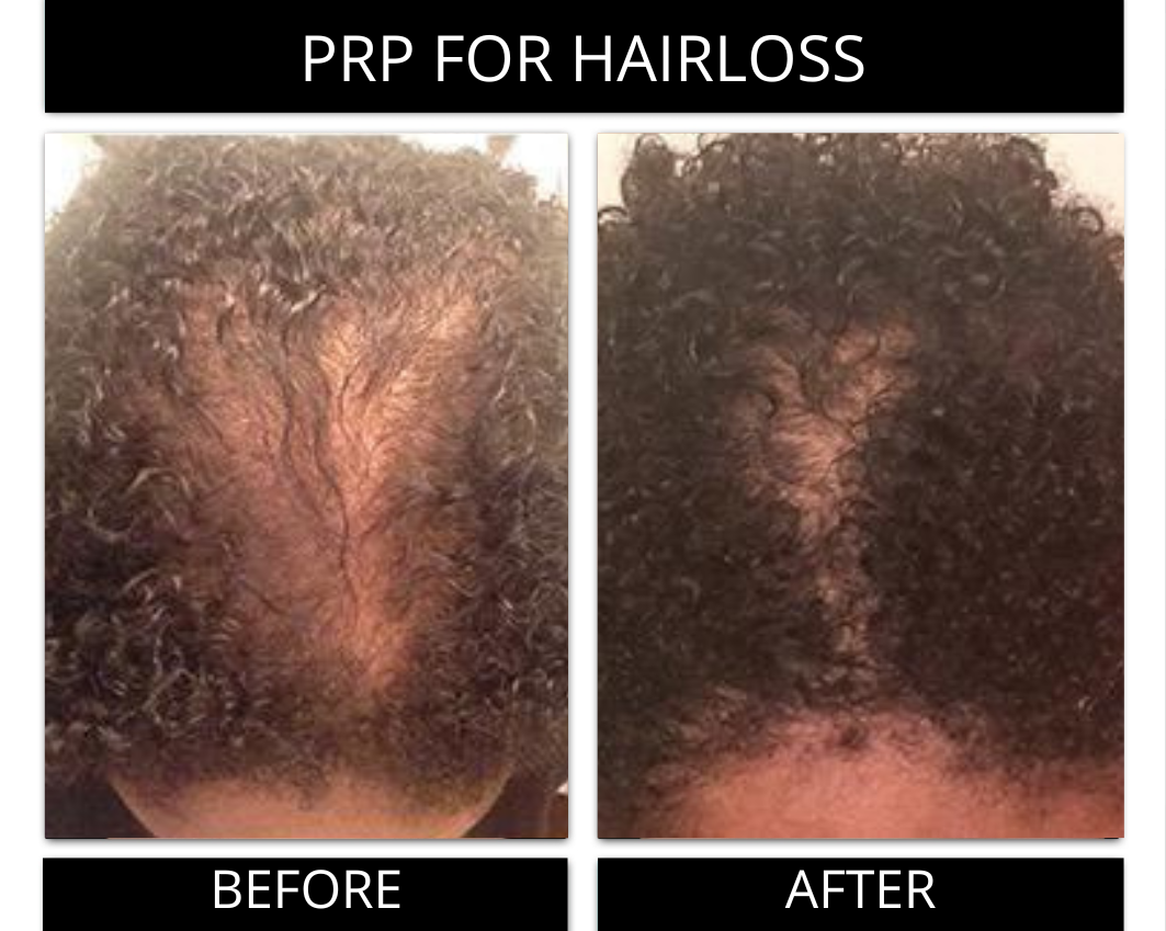 Hair Restoration Results