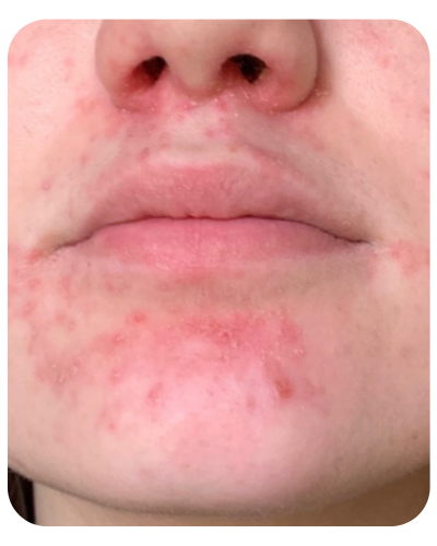 Få hjælp til behandling af Perioral dermatitis — Clinique Mirabella