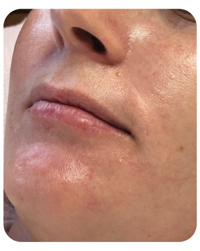 Få hjælp til behandling af Perioral dermatitis — Clinique Mirabella