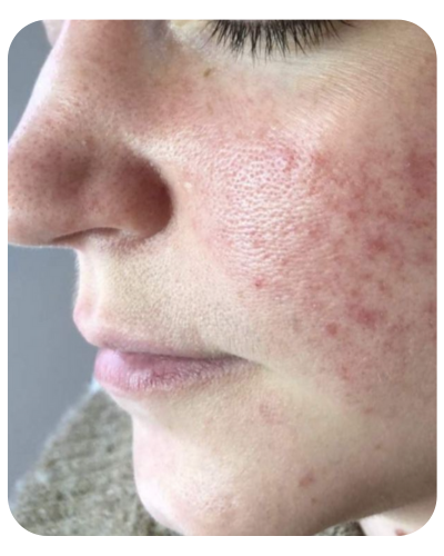 Få hjælp til Rosacea — Clinique Mirabella