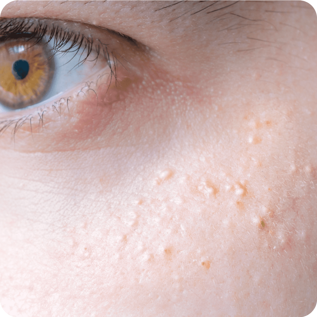 Hvide knopper — Clinique Mirabella