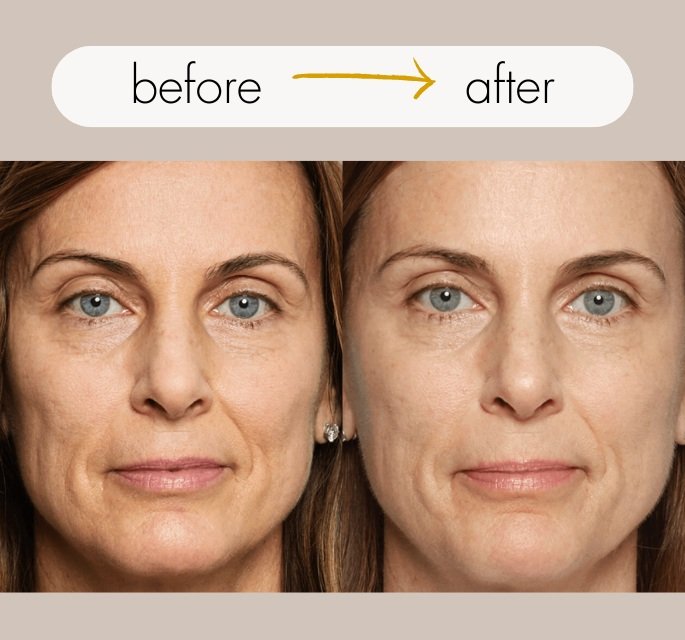 Look and Feel Younger: Natural-Looking Results with Cosmetic Injections ...