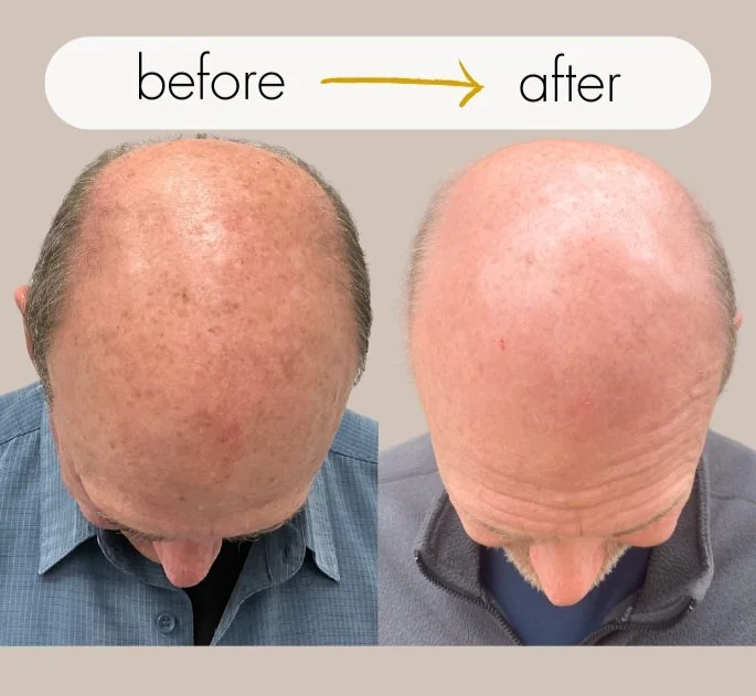 Smoother, Brighter Skin: Experience the Power of Portland's Best Laser ...