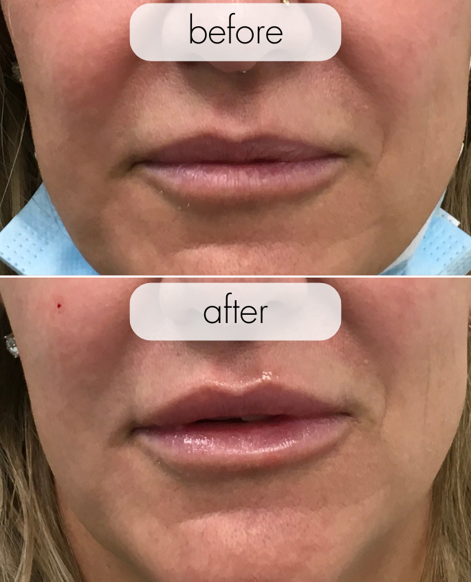 Look and Feel Younger: Natural-Looking Results with Cosmetic Injections ...