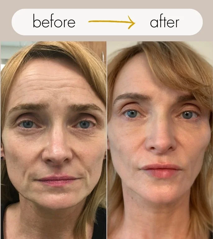 Look and Feel Younger: Natural-Looking Results with Cosmetic Injections ...
