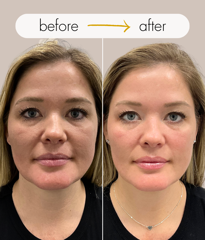 Non-Surgical Body Sculpting in Portland, Oregon: BodySculp & BodyTone ...