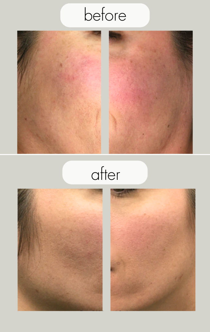 Smoother, Brighter Skin: Experience the Power of Portland's Best Laser ...