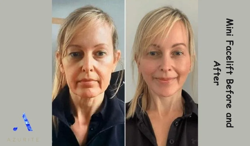 Mini Facelift Before and After Transformations